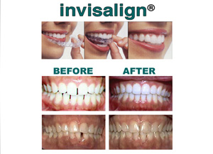 FREE 3D Scan for Invisalign Plus Outcome Simulation! - Mill Creek and ...