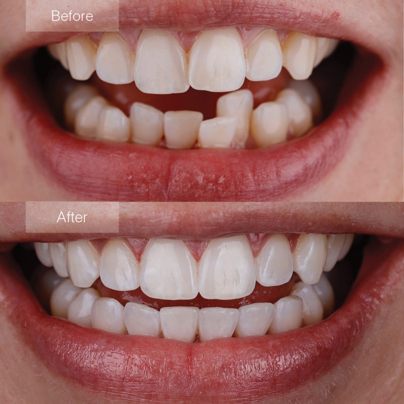Invisalign Clear Braces & Guard - Mill Creek and Northgate Dentist ...